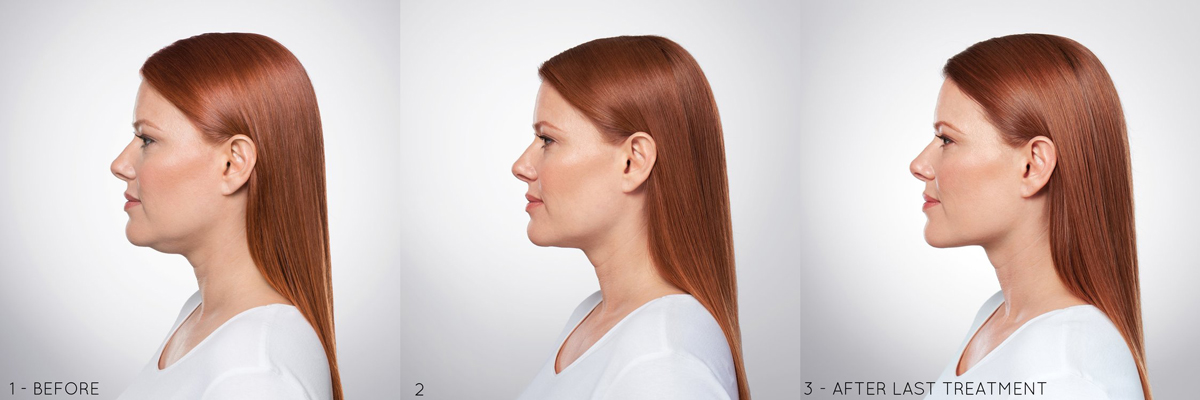 Kybella Treatments Redlands CA - Ingrid E .Trenkle, MD